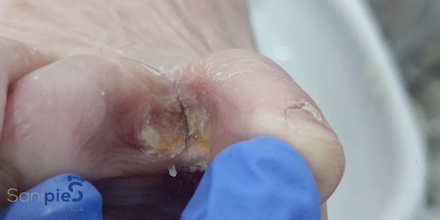 Tipos de Helomas y Cómo Tratarlos | Sanipies Centro Médico